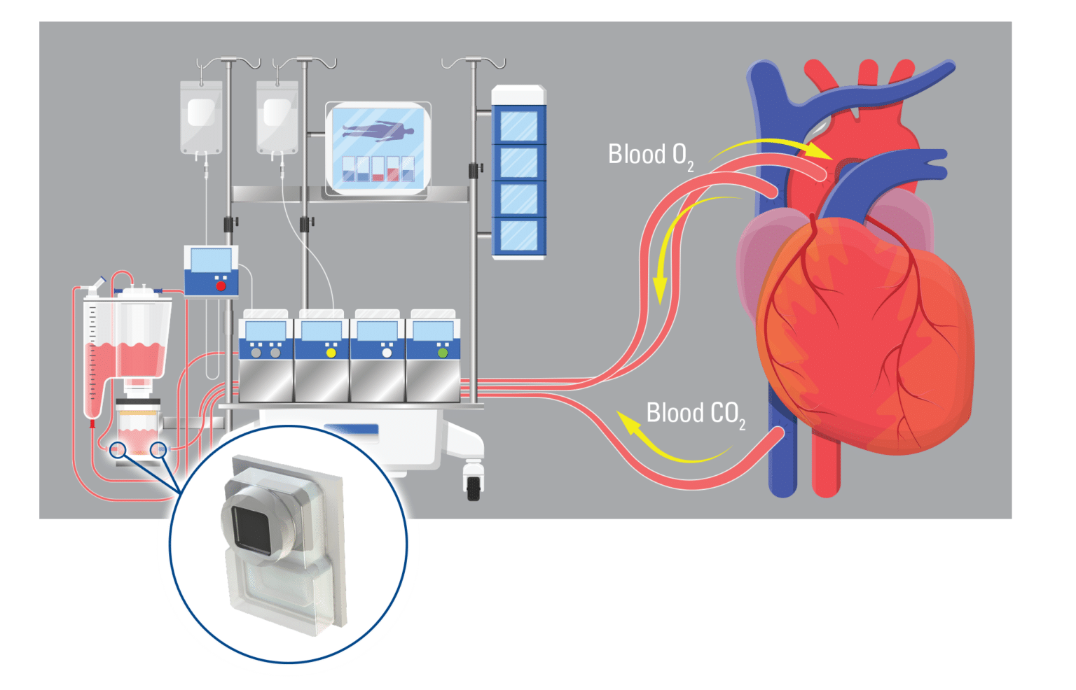 Creating Accurate Blood Pressure Sensors for Medical Equipment - Merit ...